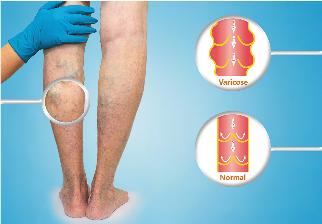 Texas Vein Experts